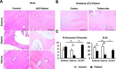 Hyperostosis Cranialis Interna Exclusively Affects The Internal Cortex Download Scientific