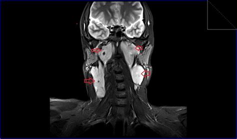 Neck Lymphoma Mri Hodgkin Lymphoma Hl