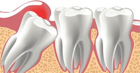 What Is An Impacted Tooth Freytag Orthodontics