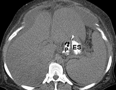 Imaging Of Bariatric Surgery Normal Anatomy And Postoperative