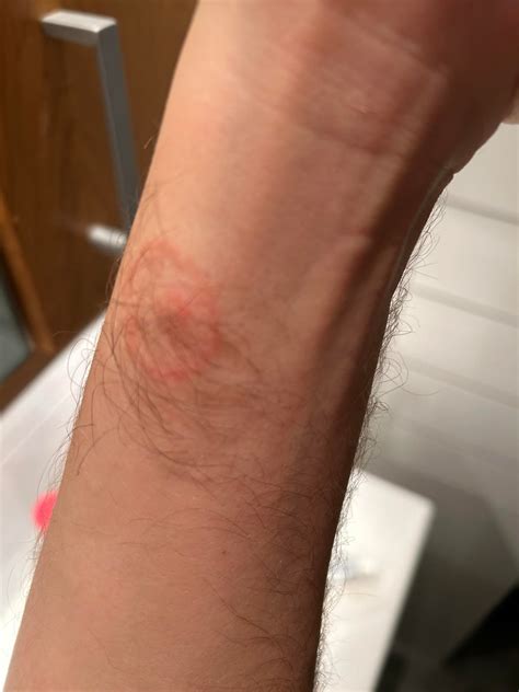 Is This A Tic Bite Or Ringworm Rukhiking