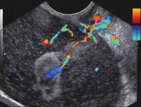 A Smooth Protuberant Mass Of Descending Duodenum Egd B