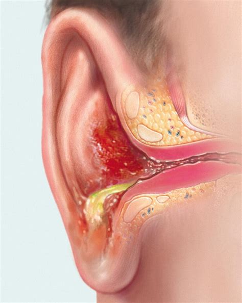External Ear Infection Staph Infection In The Ear Causes Symptoms