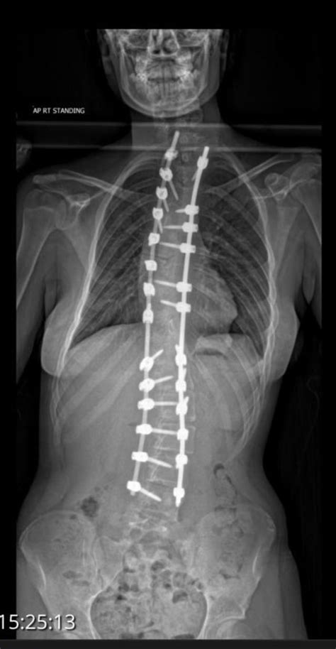 Got My Xrays Ahhh R Scoliosis