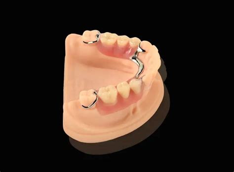 Printed Partial Framework — Co Cr And Acrylic Partial Denture By