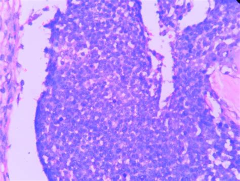 Pilomatricoma Histopathologyguru