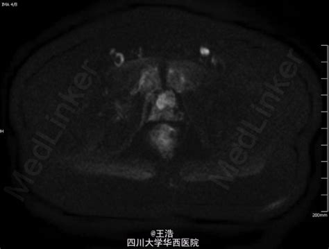 前列腺癌转移至直肠误诊为直肠癌一例 医联