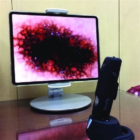 The Dermoscope On The Left Delivers Polarised Non Contact Dermoscopy