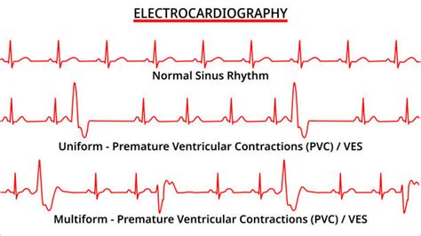 Premature Ventricular Contractions Ecg