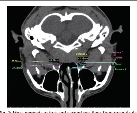 Lateral Pterygoid Muscle Location In Relation To Preauricular Skin