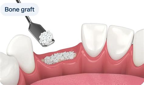 Can I Get A Tooth Pulled And A Dental Implant The Same Day Clearchoice