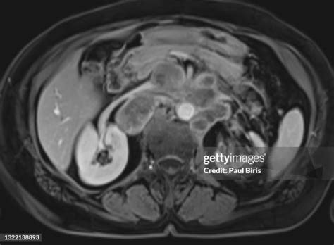 Parts Of The Pancreas Photos And Premium High Res Pictures Getty Images