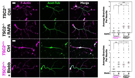 Tuberous Sclerosis Complex Waisman Center Uwmadison