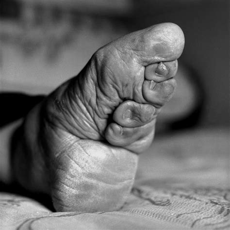 Foot Binding Infection