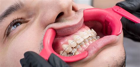 How To Avoid Staining Clear Braces Stosich Consulting Avoid Staining Your Clear Braces