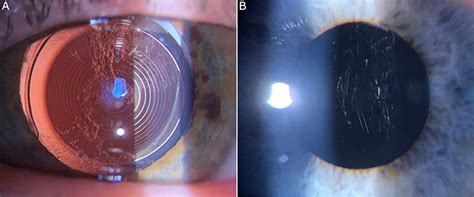 Early Ndyag Laser Capsulotomy Improving Visual Performance Opth