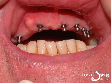 Dentures Before And After Cosmic Smile Dental