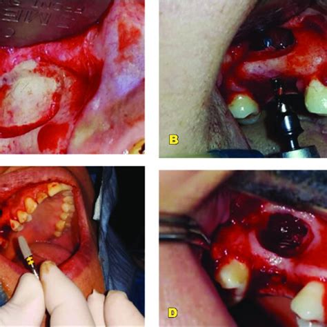 A Photoradiograph Showing Sinus Pneumatization White Arrow Download Scientific Diagram