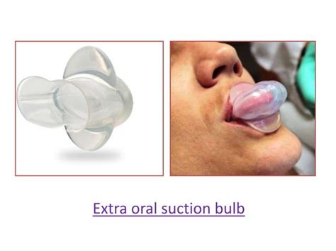Role Of Mandibular Advancement Splint In Sleep Apnoea Pptx Ear
