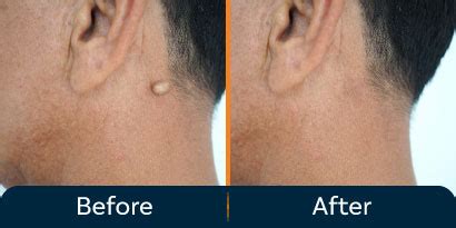 Before And After Photos Of Sebaceous Cyst Treatment