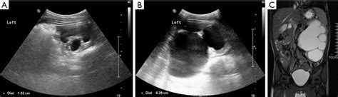 Asymptomatic Obstructive Hydronephrosis Associated With Diabetes