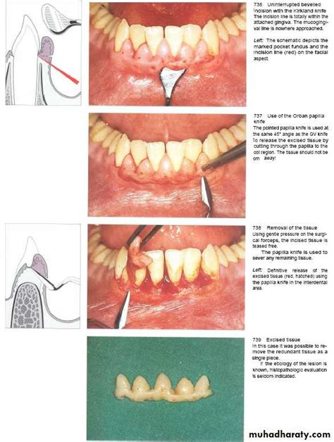 Gingivectomy Pptx د هدى Muhadharaty