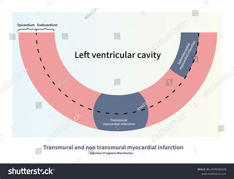 Clinically Transmural Myocardial Infarction Usually Produces Stock