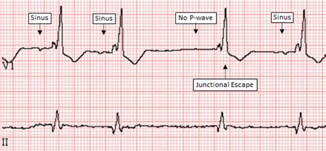 Junctional Escape Beat Ecg Junctional Rhythm Junctional Escape