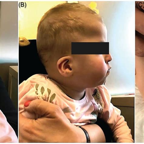 A Characteristic Dysmorphic Facial Features Including High Anterior