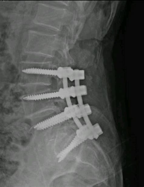 Ali Keipour On Linkedin The Patient Was A 60 Year Old Woman With A Grade 2 Meyerding Score Canal…