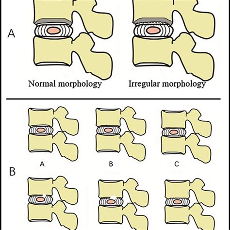 A Endplate Morphology Normal Endplate Morphology Is Scored As 0