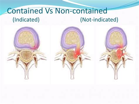Ppt Paper Presentation Percutaneous Discectomy Pptx