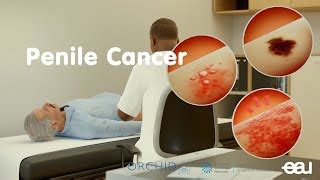 Penile Carcinoma