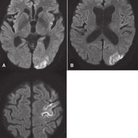 Diffusion Weighted Mri On Re Admission Diffusion Weighted Images