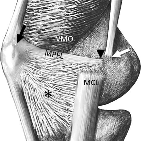 Normal Mr Imaging Anatomy Of The Medial Patellofemoral Ligament Mpfl