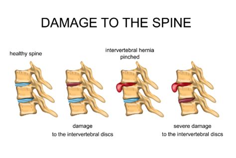 How Chiropractic Keeps Spinal Joints Healthy Stover Chiropractic P C