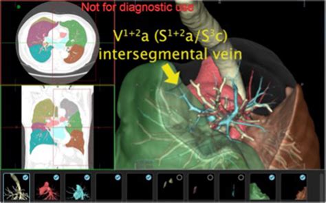 Segmentectomy Oriented Anatomical Model For Enhanced Precision Surgery