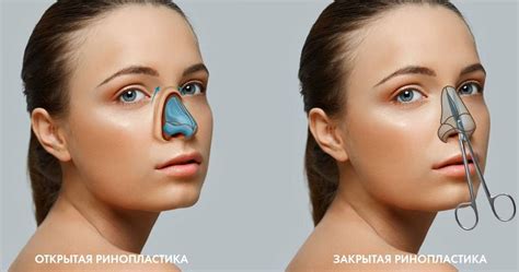 Инъекционная ринопластика