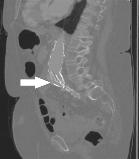 Type Iiia Endoleak Repair Complicated By Glue Embolization Eurorad