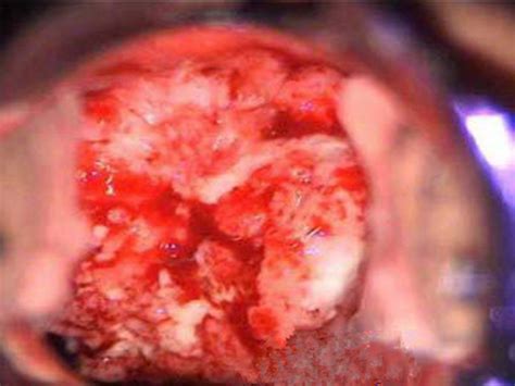 宫颈糜烂图片宫颈糜烂症状表现图片大全有来医生