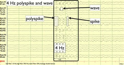 Idiopathic Generalized Epilepsy