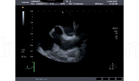 Figure 5 From Echocardiography Evaluation In Ecmo Patients Semantic