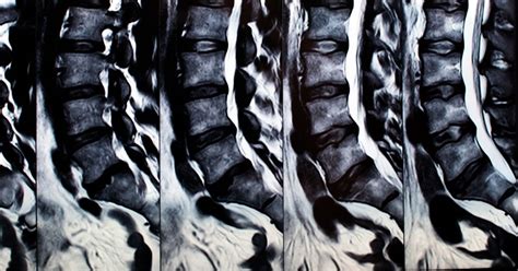 Magnetna Rezonanca Kičme Mr Kičme