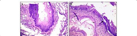 A Photomicrograph Showing Apoptotic Malignant Epithelium Cells Arrows