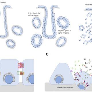 Illustration Of The Development Of Diffuse Gastric Cancer In E Download Scientific Diagram