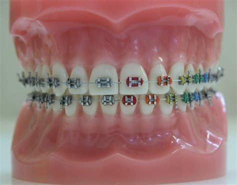 Colorful Braces When Someone Needs Braces He Or She Can Choose