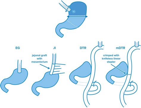 Frontiers Indications And Technical Aspects Of Proximal Gastrectomy