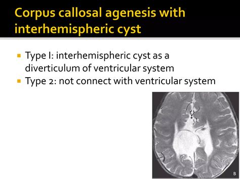 Congenital Brain Anomalies Pdf