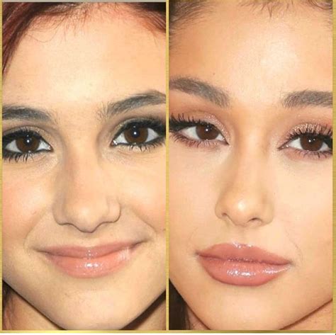 Ariana Grande Rhinoplasty Nose Jobs Rhinoplasty Celebrity Plastic