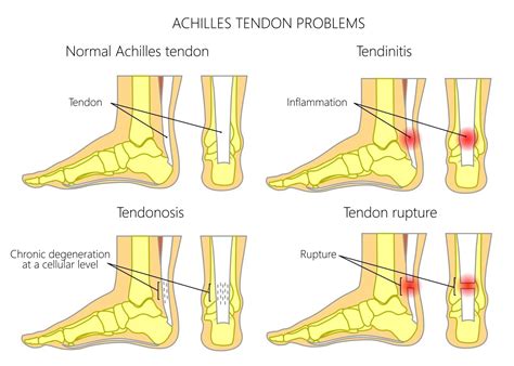 Extensor Tendonitis